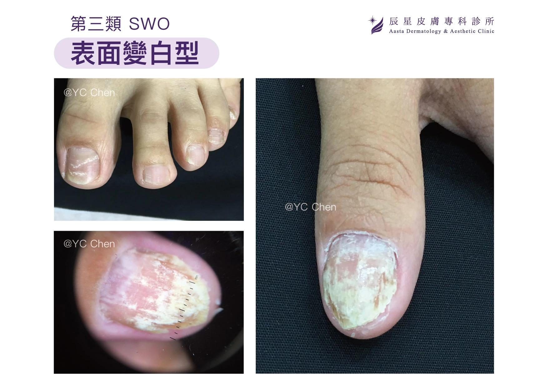 灰指甲｜辰星皮膚專科診所—指甲專科/醫美/雷射治療 - 辰星皮膚專科診所